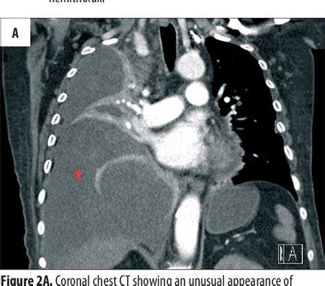 Loculated Pleural Effusion Ct Pleural Effusion Is Classically Divided