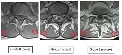 Multifidus Fatty Infiltration On Mri Adelaide Sports