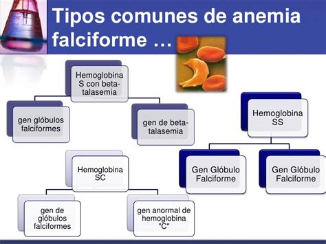 Anemia Falciforme