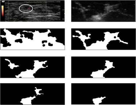 Effects Of Threshold Level On Binary Segmentation A Power Doppler