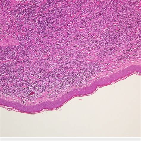 Histology Of Punch Skin Biopsy Hande Magnified 10x A Uninvolved