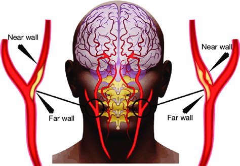 Carotid Artery Stenosis Chart