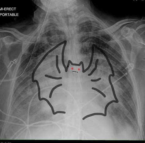 Batwing Pattern Aka Butterfly Pattern On Cxr The Common Vein