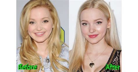 All About Dove Cameron Plastic Surgery Operations