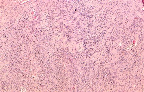 Benign Proliferation Of Spindle Shaped Cells Arranged In Characteristic