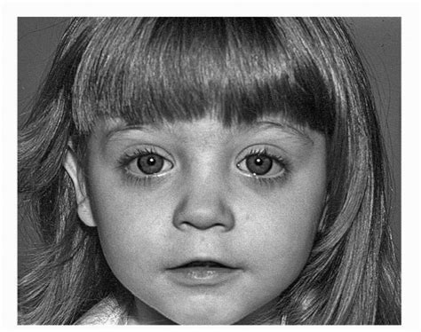 Fetal Alcohol Syndrome Adults Face