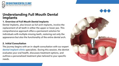 Ppt Full Mouth Dental Implants What To Expect During The Procedure