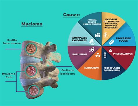 Multiple Myeloma Bone Marrow Transplant Options In India