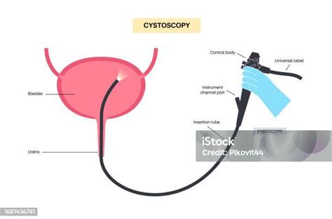 Cystoscopy Examination Concept Stock Illustration Download Image Now