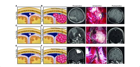 For Different Anatomical Type Of Arachnoid Granulation Schematic Download Scientific Diagram