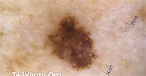 Dermoscopy Of Superficial Spreading Melanoma Image
