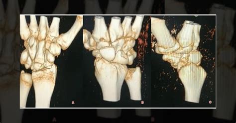 Best Suited Treatment Approach For Palmar Trans Scaphoid Perilunar Dislocation In An Adult Man