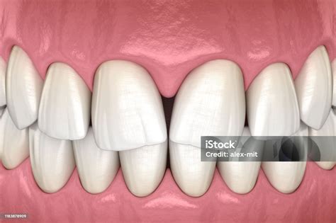 중앙 절개 치아의 수렴 디아스테마 치과 기능 장애 3d 일러스트 개념 개선에 대한 스톡 사진 및 기타 이미지 개선 디자인
