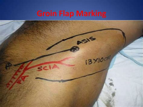 Superficial Circumflex Iliac Artery Perforator Flap Ppt