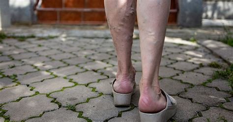 Your Guide To The Different Types Of Thrombosis