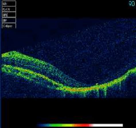 Chorioretinal Degeneration With Retinal Pigment Epithelial Atrophy Download Scientific Diagram