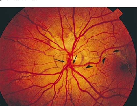 Angioid Streaks Of The Retina