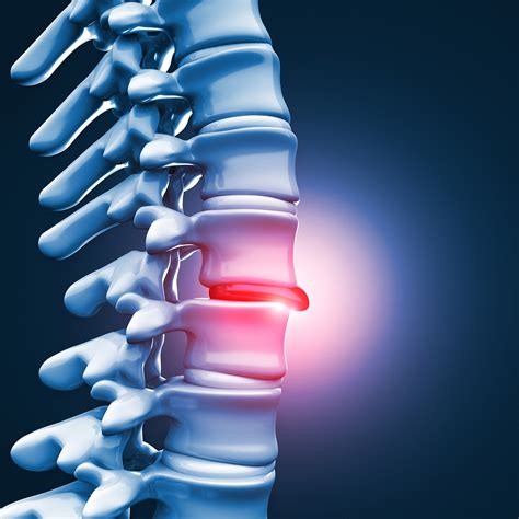 Why You Need To Try Spinal Decompression For Your Herniated Disc Dr
