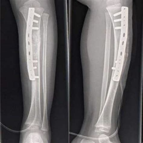 Preoperative Radiography Right Cruris Showing Geographic Lytic Lesion