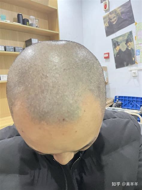 不花钱治好毛囊炎 知乎