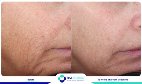 แก้ปัญหาผิว ฝ้า กระ จุดด่างดำ ลบรอยสัก ด้วย Pico Laser