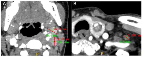 Radiomics Profiling Identifies The Value Of Ct Features For The Preoperative Evaluation Of Lymph