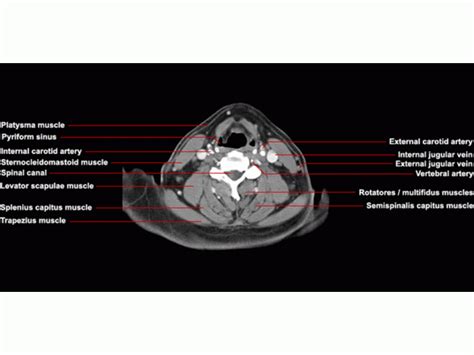 Ct Neck Axial Anatomy Radiologypicscom Anatomy Of The Neck