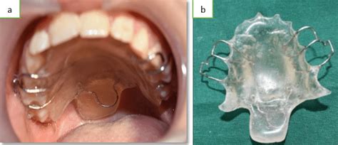 A Palatal Lift Appliance In Situ B Palatal Lift Prosthesis Ex Situ