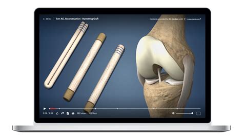 Torn Acl Hamstring Graft Animation