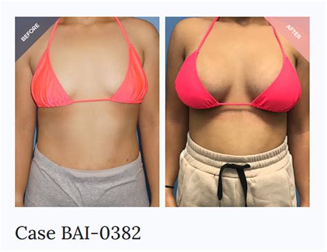 Breast Augmentation Before And After A To C