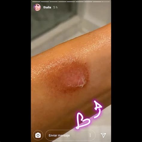 “mi Mente Se Sobrepone Al Dolor” Thalía Sufrió Una Horrenda Quemadura