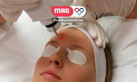 درمان جای جوش با لیزر