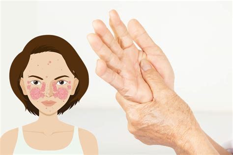 Lupus Eritematoso Sistemico Cause E Sintomi Farmaci E Cure
