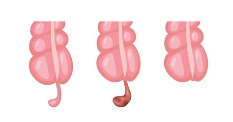 Appendicitis Inflammation Developing In Three Stages From Normal Appendix To Infected Appendix