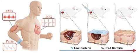 Mxene Hydrogel Based Antibacterial Epidermic Sensors