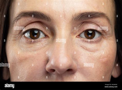 Tired Eyes Bags