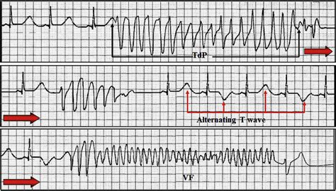 Congenital Lqt3 Qtc 670 Ms Run Of Tdp After Macro Wave T Alternans