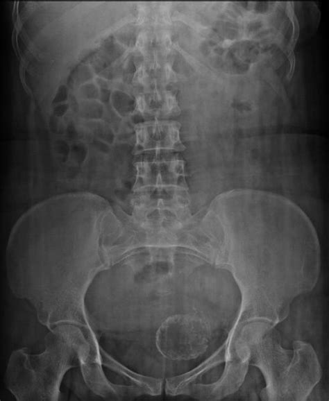 Uterine Leiomyoma Pacs