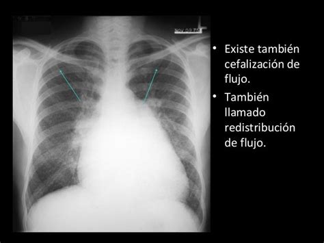 Edema Agudo De Pulmon