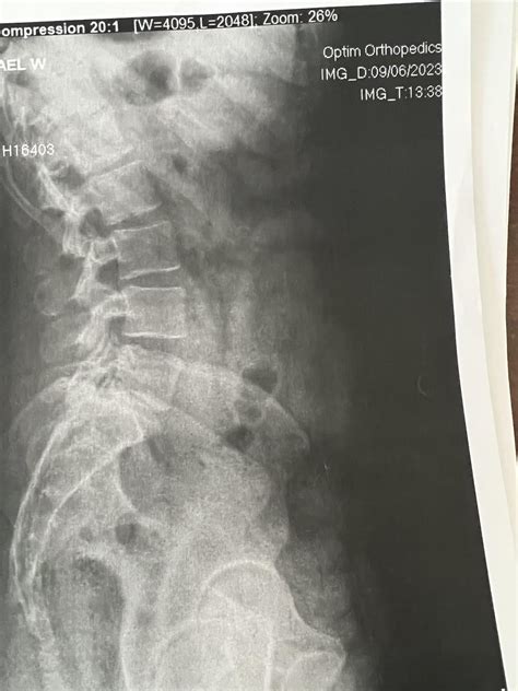 So Just Got The Mri R Sciatica