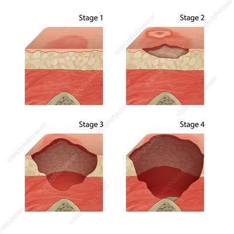 Wounds Pressure Ulcers Staging