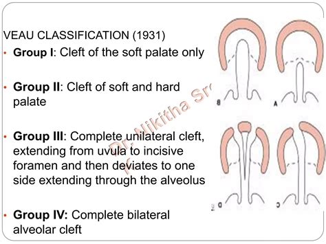 Surgical Management Cleft Lip And Palate Pptx