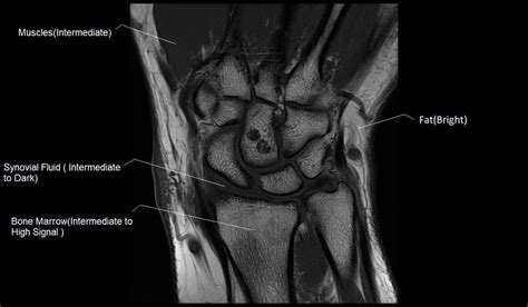 Mri Anatomy Wrist Radiology At Christy Redfield Blog