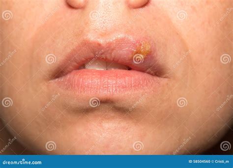 Cold Sore Stock Photo Image Of Macro Dermatology Disease