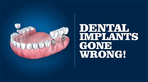 Dental Implants Gone Wrong Richardsons Plastic Surgery Hospitals
