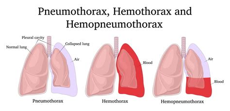 S2 E054 Pleural Disease For The Pance