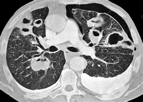 Bacterial Pneumonia Ct Scan Stock Image C0345694 Science Photo