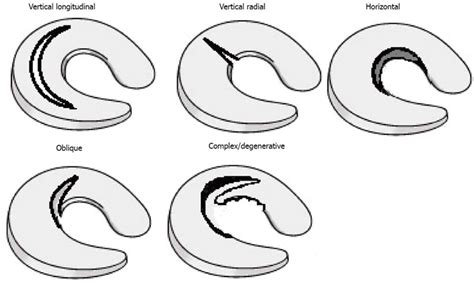Treatment Of Meniscal Tears An Evidence Based Approach