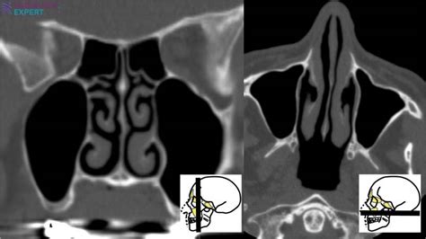 Ct Sinus