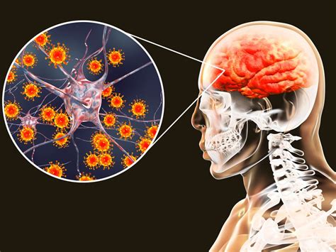 Triada Epidemiológica Meningitis Genially